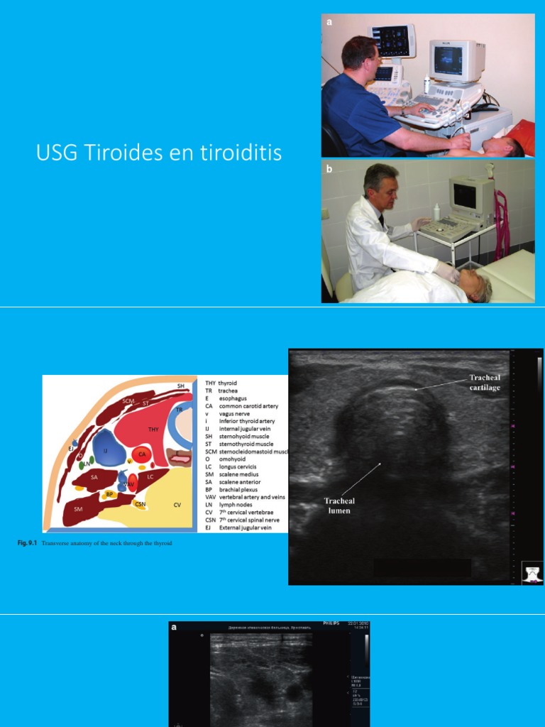 Usg Tiroiditis | PDF | Thyroid | Medical Ultrasound