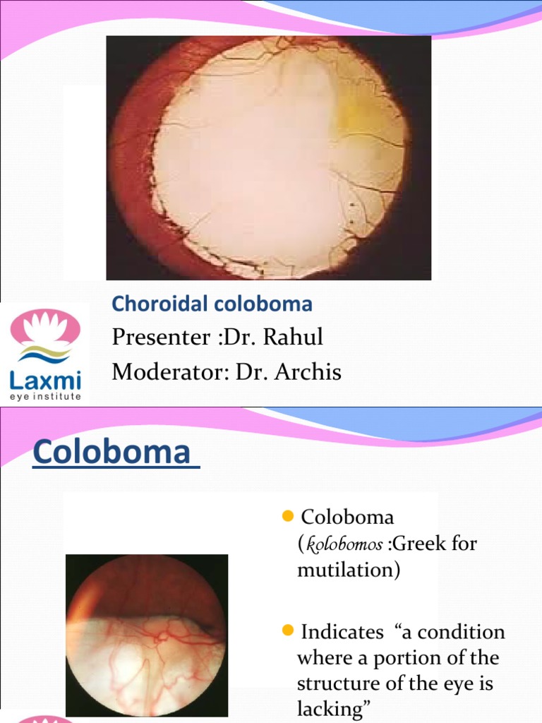 Choroidal Coloboma: Presenter:Dr. Rahul Moderator: Dr. Archis | PDF ...