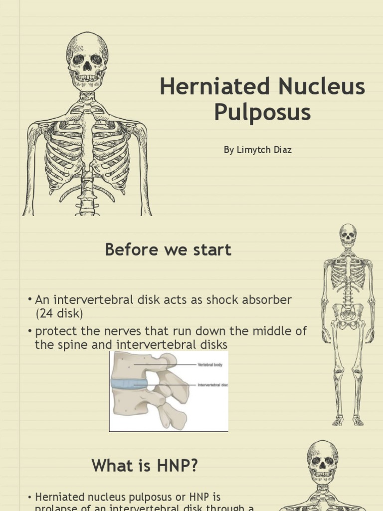 Herniated Nucleus Pulposus: by Limytch Diaz | PDF | Back Pain | Human ...