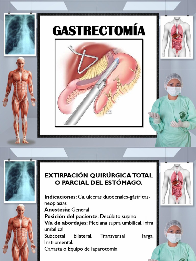 GASTRECTOMIA | PDF | Procedimientos médicos | Estómago
