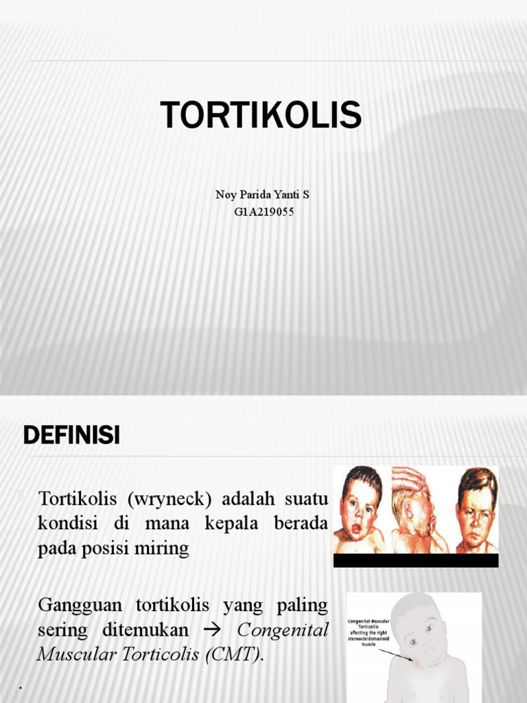 Tortikolis | PDF