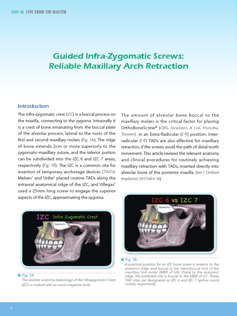 Guided Infra-Zygomatic Screws: Reliable Maxillary Arch Retraction | PDF ...
