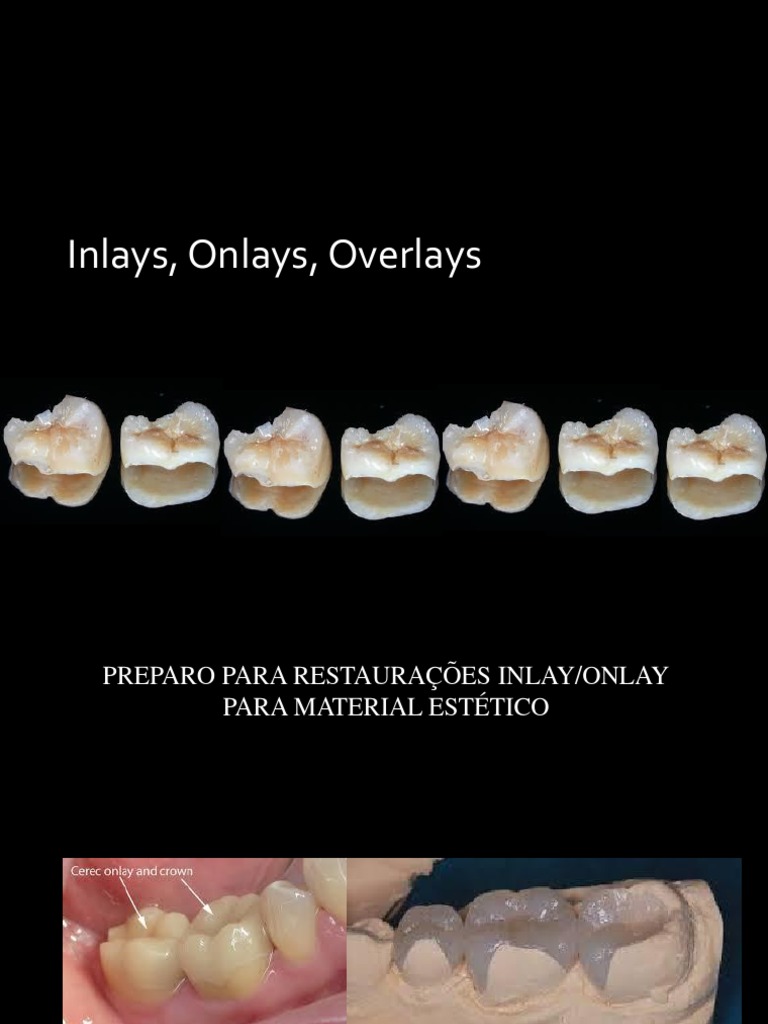 05 - Inlay, Onlay e Overlay (31!08!17) | PDF | Odontologia | Boca