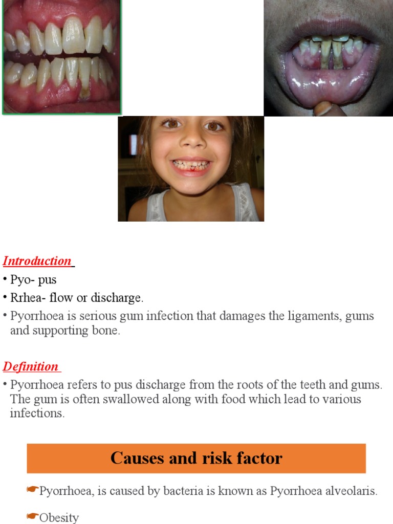 Pyorrhoea | PDF | Periodontology | Dentistry Branches