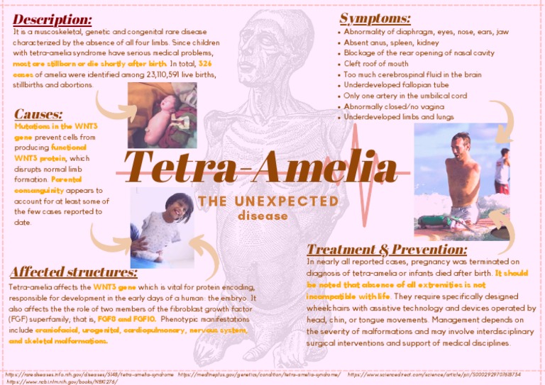 Tetra Amelia | PDF | Congenital Disorder | Genetics