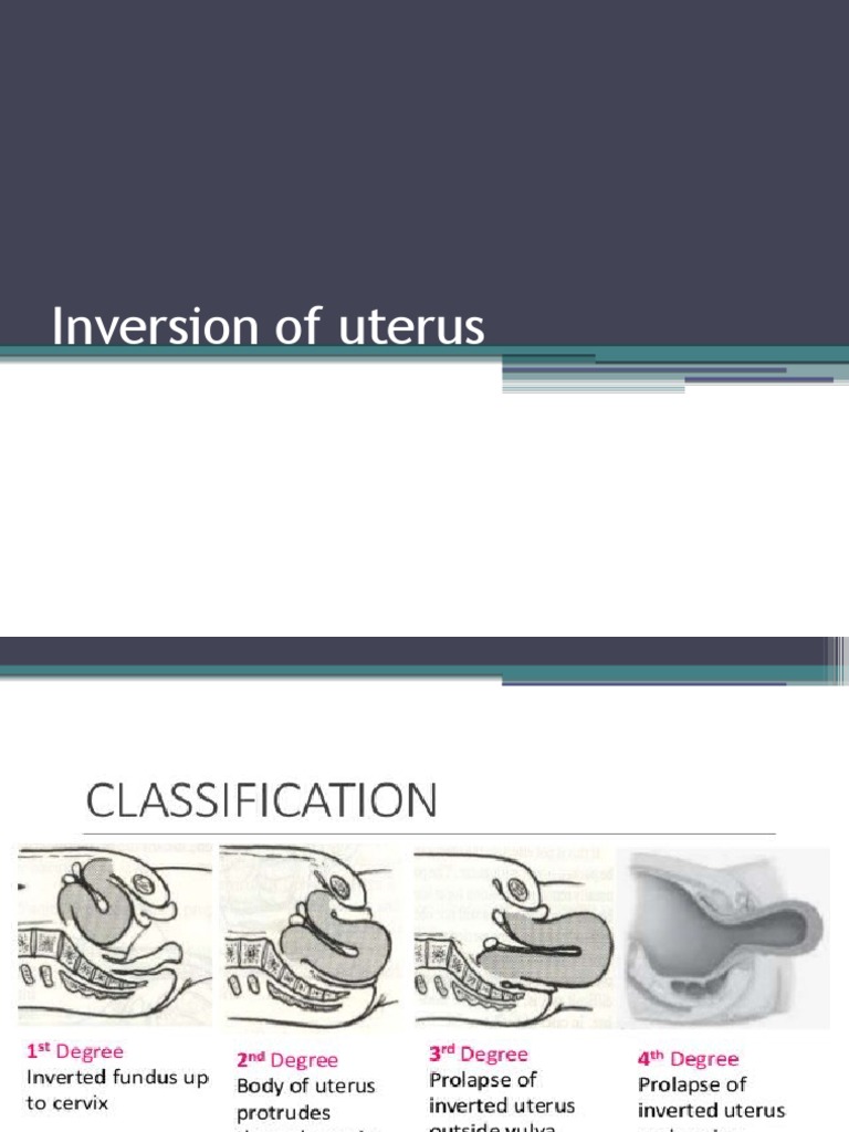 Inversion of Uterus | PDF
