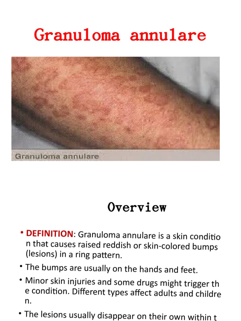 Granuloma Annulare | PDF | Topical Medication | Therapy