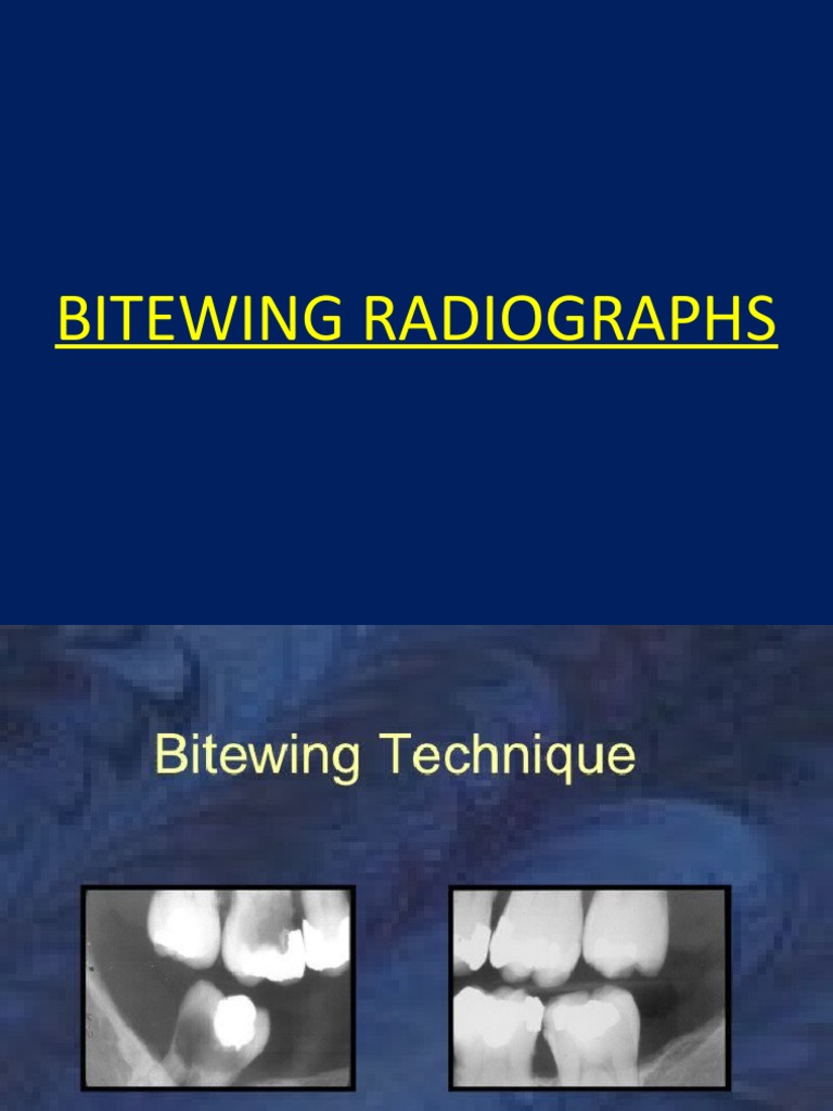 Bitewing Radiographs: Indications & Techniques | PDF