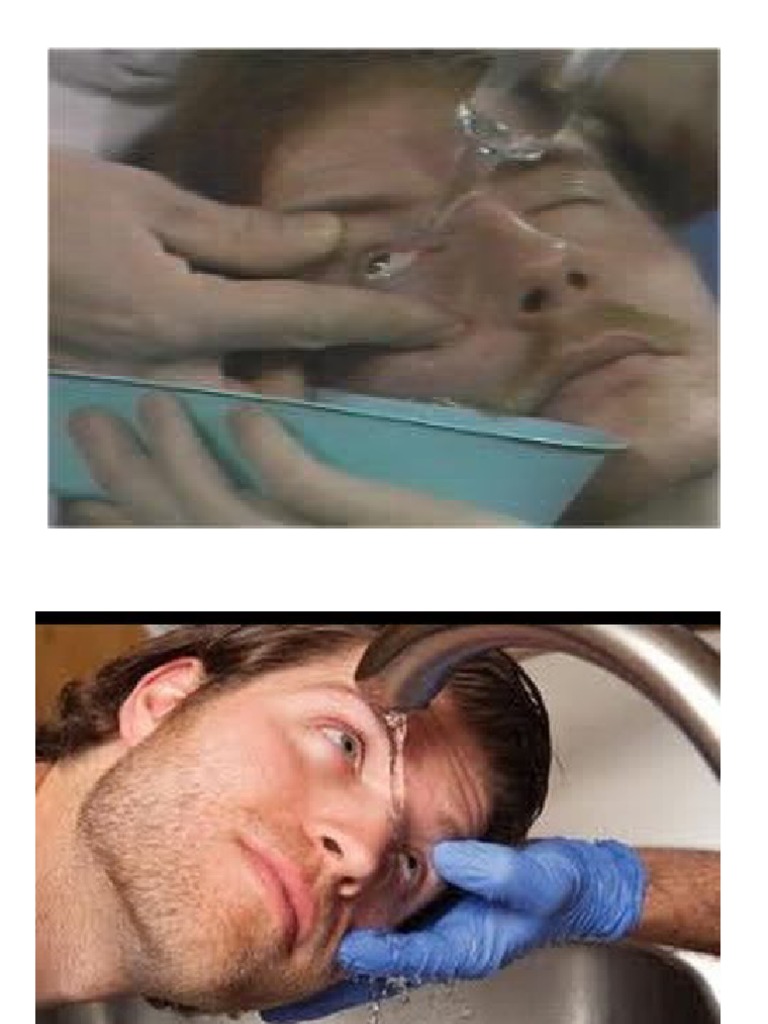 Eye Irrigation | PDF | Ear | Medical Specialties