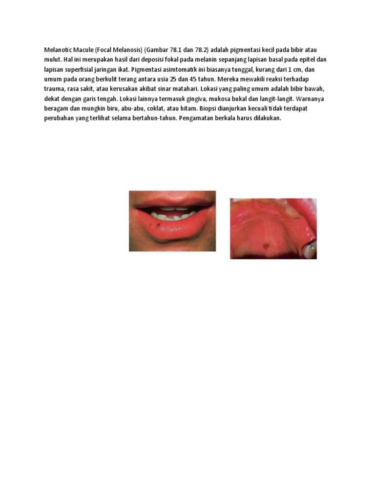 Melanotic Macule dan Melanoma Oral | PDF | Politik | Ilmu Sosial