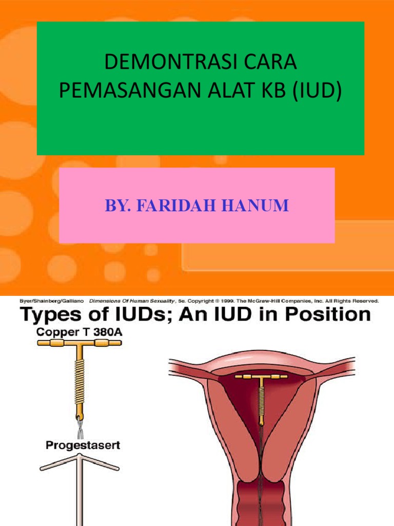 Demontrasi Cara Pemasangan Alat KB (Iud) | PDF