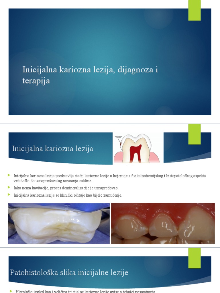 Inicijalna Kariozna Lezija, Dijagnoza I Terapija | PDF