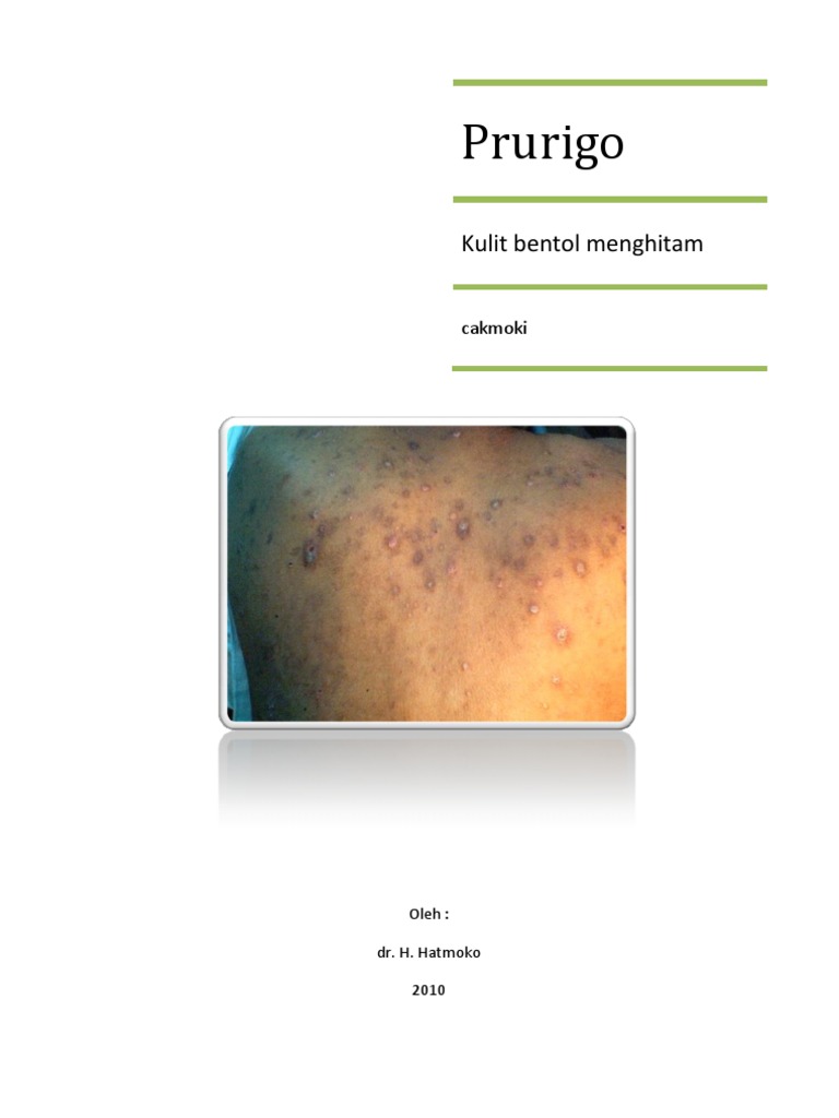 Prurigo von Hebra: Gejala dan Pengobatan | PDF