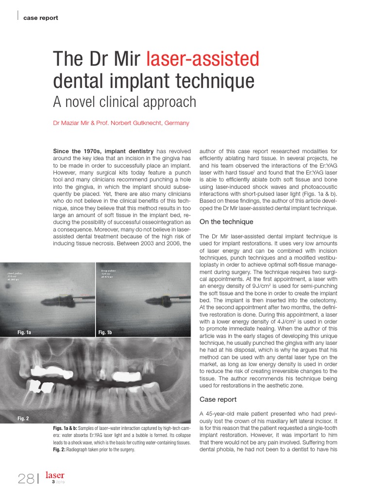 The DR Mir Dental Implant Technique: Laser-Assisted | PDF | Dental ...