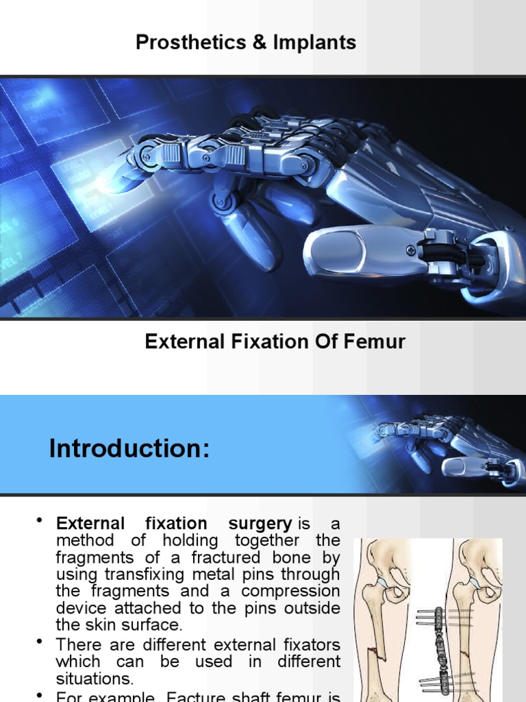 External Fixation Techniques for Femur | PDF | Orthopedic Surgery ...
