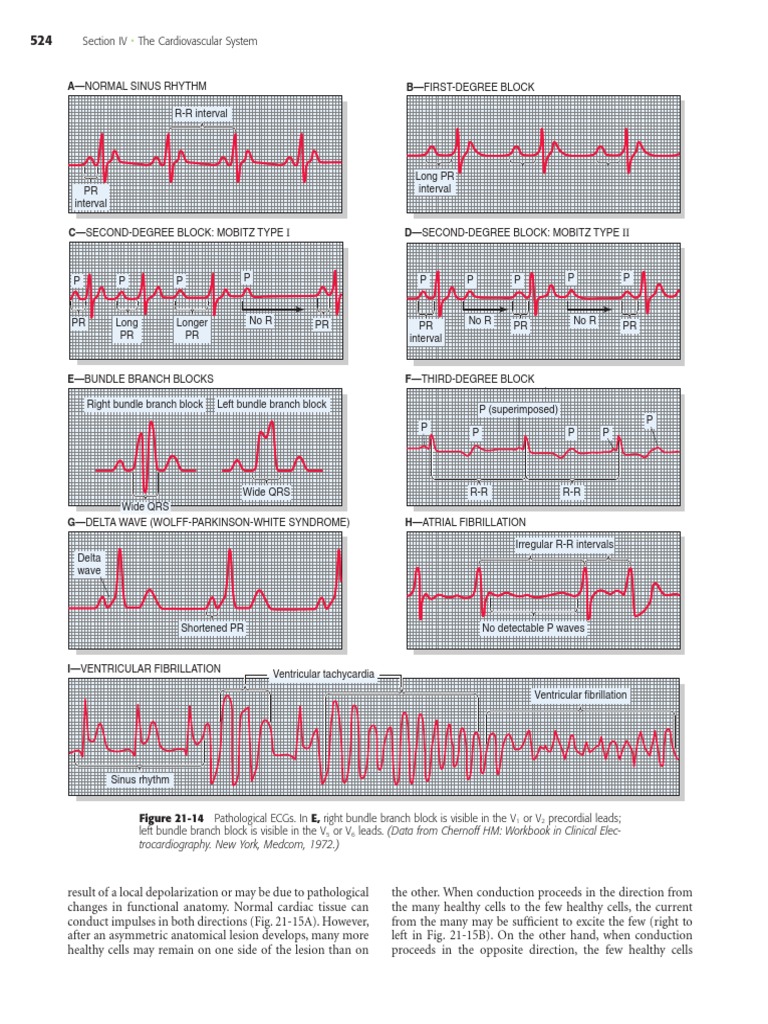 Aritmije Boron | PDF | Electrocardiography | Electrophysiology