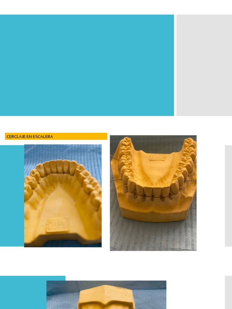 Presentación2 Ciru Ligaduras | PDF
