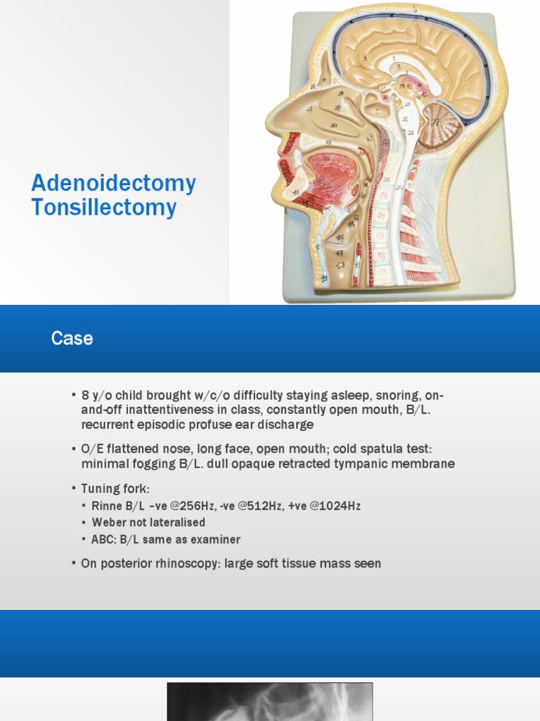 Adenotonsillectomy | PDF | Medical Specialties | Medical Procedure/Test