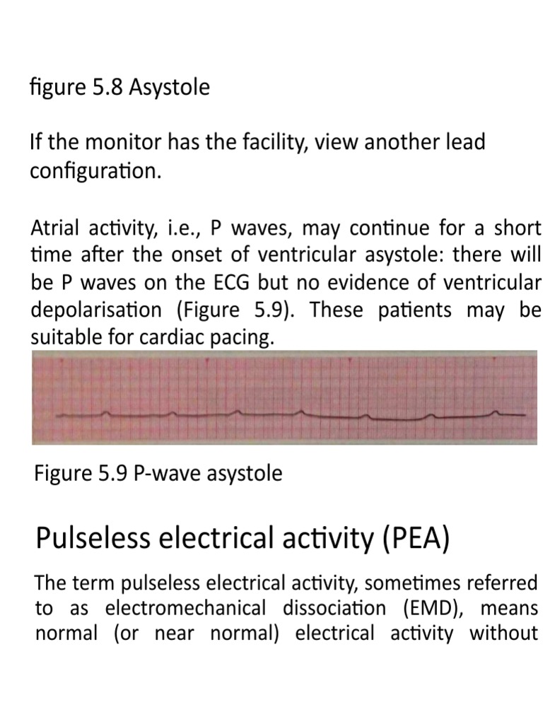 Pulseless Electrical Activity Vs Asystole