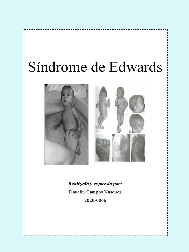 Sindrome de Edwards | PDF | Genética | Especialidades Medicas