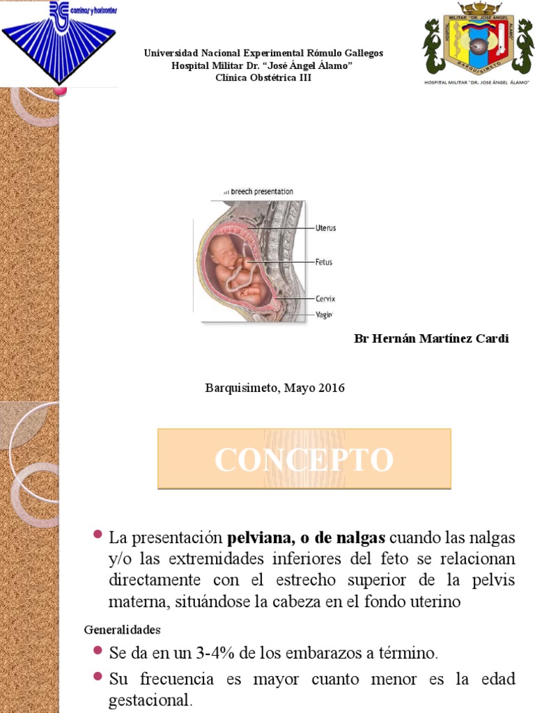 Parto Podálico: Manejo y Consideraciones | PDF | Pelvis | Parto