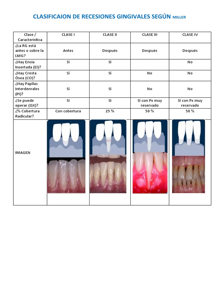 Tabla Clasificación Recesiones Gingivales | PDF