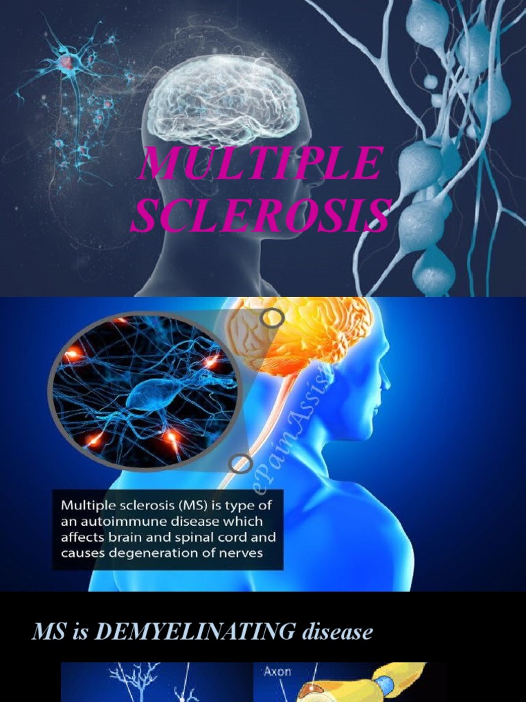 Multiple Sclerosis | PDF | Multiple Sclerosis | Myelin