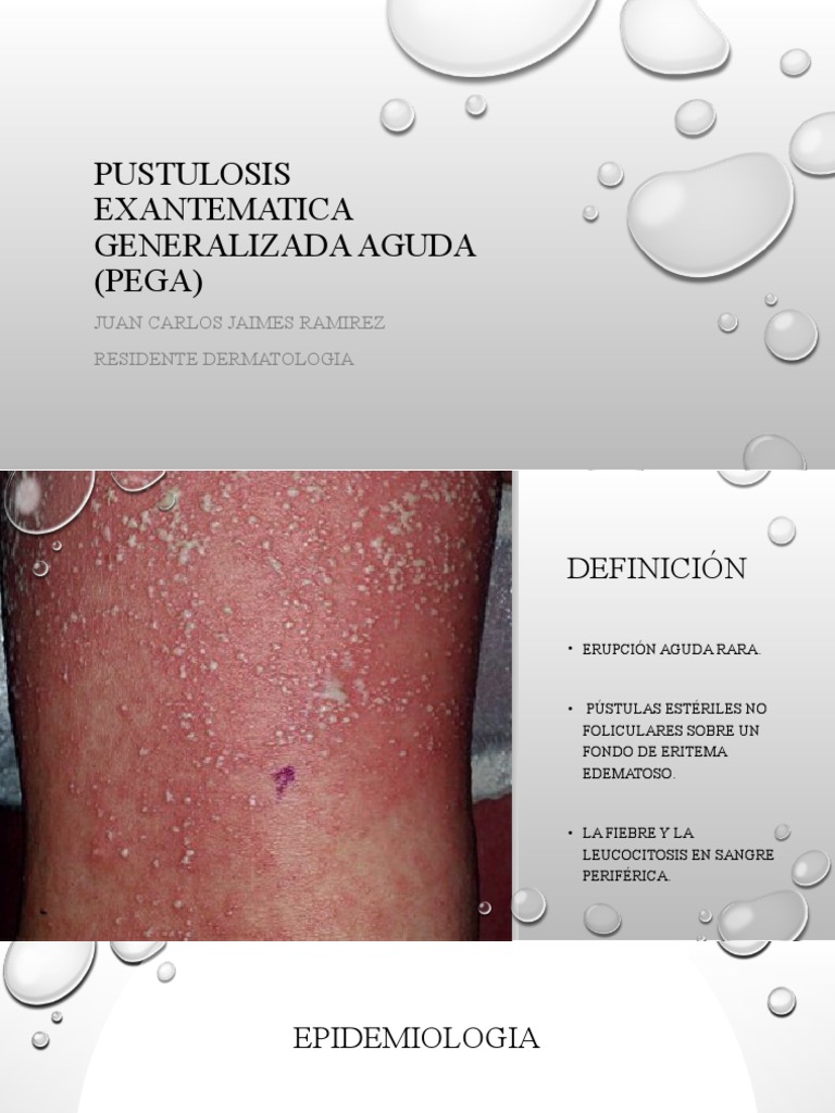 Pustulosis Exantematica Generalizada Aguda (PEGA) : Juan Carlos Jaimes ...