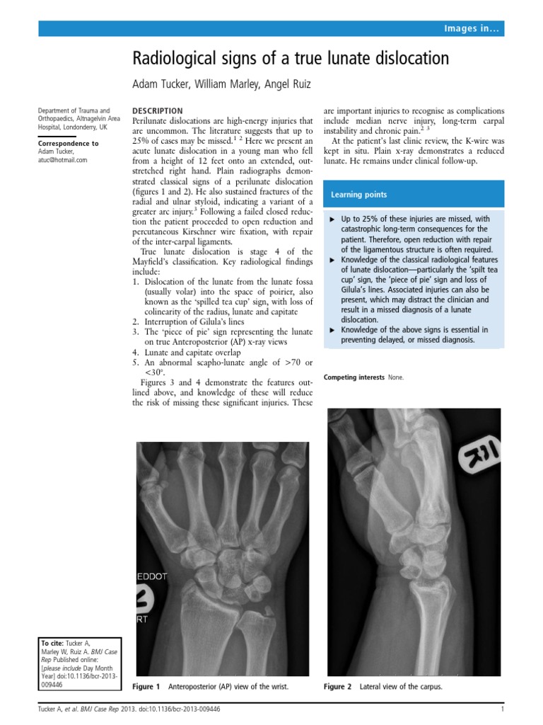 Lunate Dislocation Pie Sign