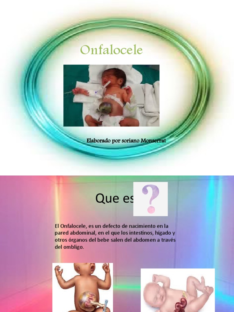 Onfalocele | PDF | El embarazo | Síndrome de Down