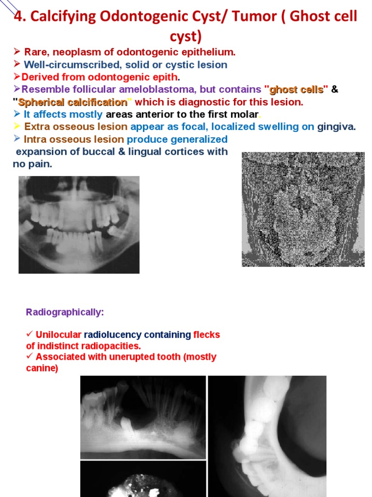 Calcifying Odontogenic Cyst Overview | PDF | Metastasis | Neoplasms
