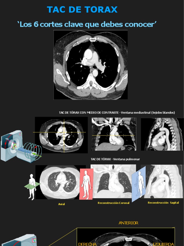 Tac de Tórax | PDF | Aorta | Pulmón