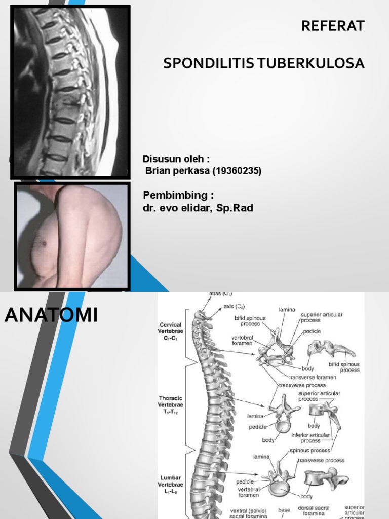 Spondilitis TB Brian (Radiologi) | PDF