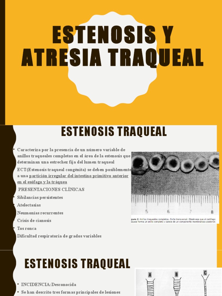 Estenosis y Atresia de Traquea | PDF | Tos | Enfermedades y trastornos ...