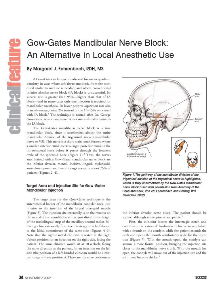 Gow Gates Nerve Block | PDF | Dentistry | Anesthesia