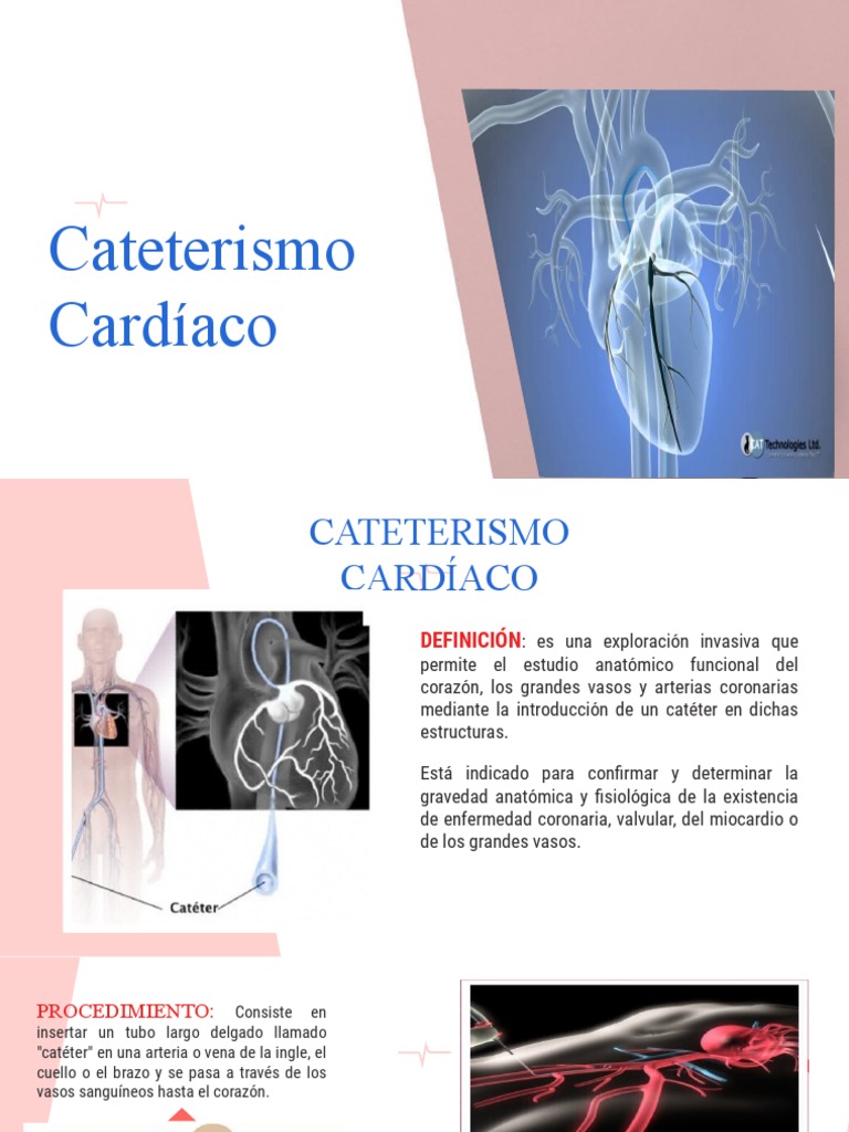 Cateterismo Cardiaco | PDF