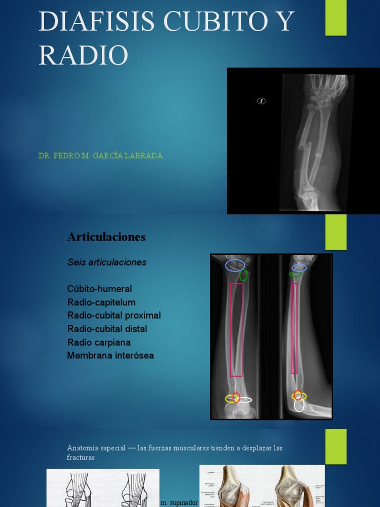 C-7 Fract Diafisis Cubito y Radio | PDF | Enfermedades y trastornos ...
