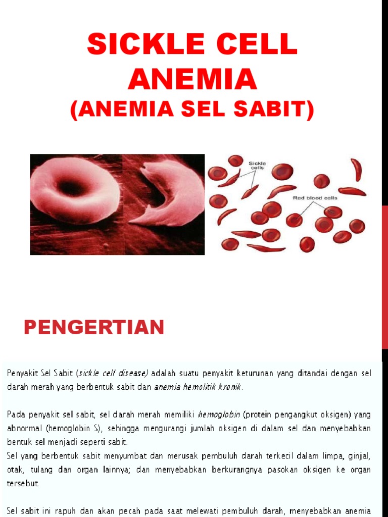 Sickle Cell Anemia | PDF