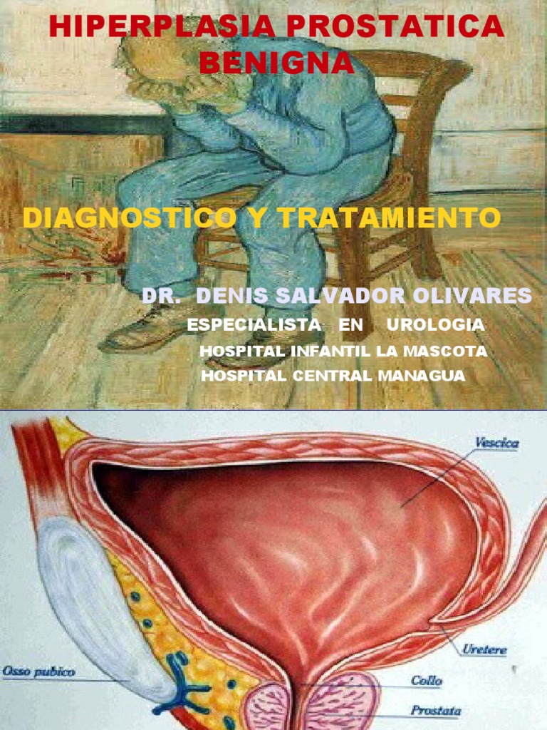 Hipertrofia Prostática Benigna | PDF | Urología | Medicina
