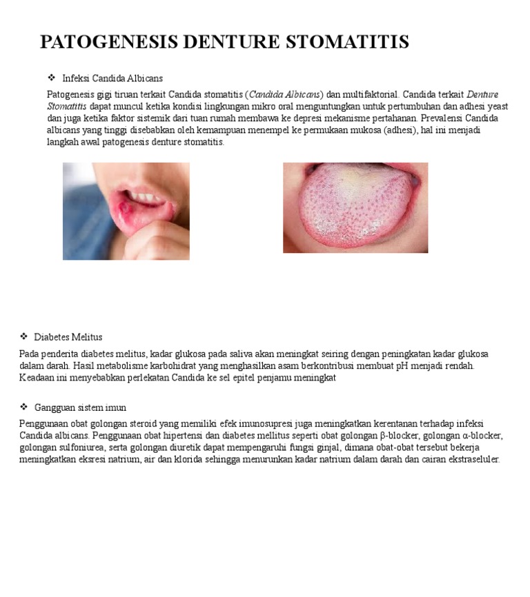 Patogenesis Denture Stomatitis dan Candida | PDF | Kesehatan Holistik
