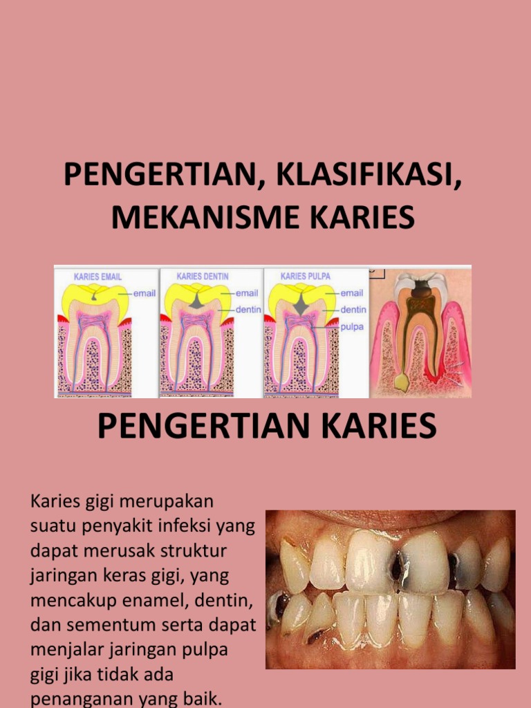 Karies | PDF