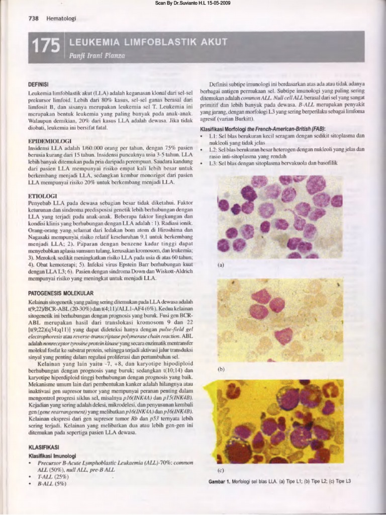 Bab 175 Leukemia Limfoblastik Akut | PDF