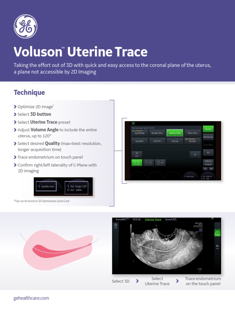 Voluson Uterine Trace Quick Guide 2021 | PDF
