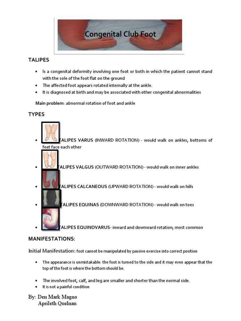 Congenital Club Foot | PDF | Musculoskeletal System | Diseases And ...