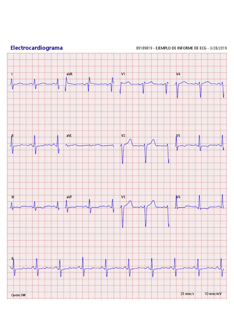 Informe de ECG: Ritmo No Clasificado | PDF