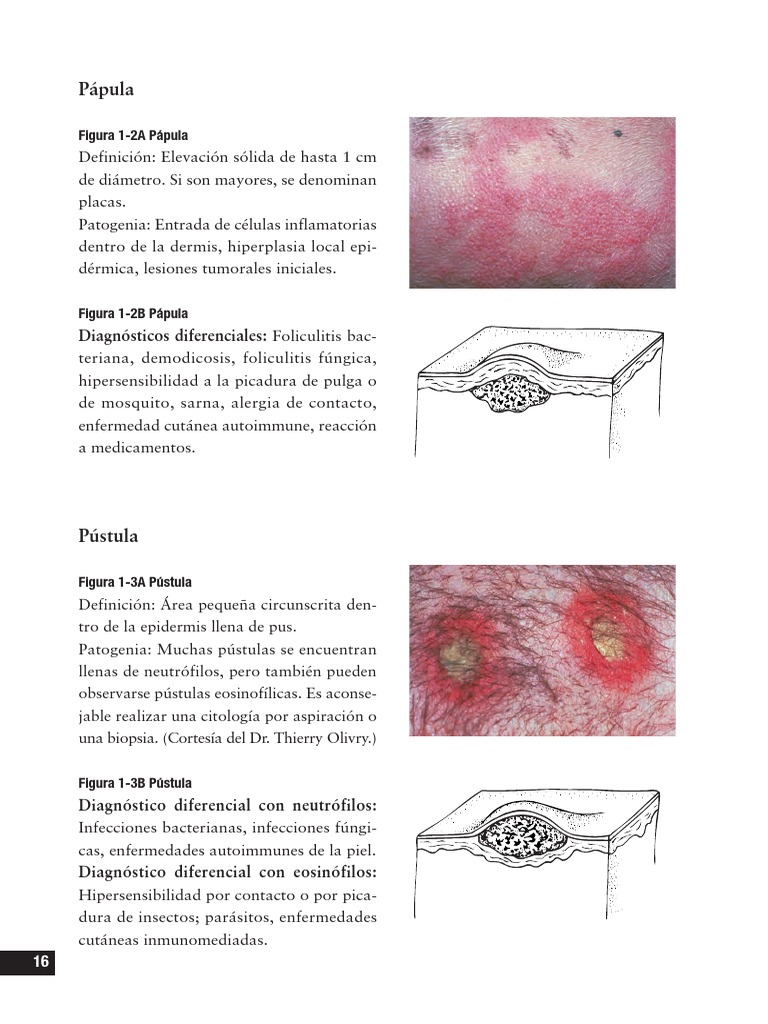 Pápula. Pústula. Figura 1-2A Pápula. Figura 1-2B Pápula. Figura 1-3A ...