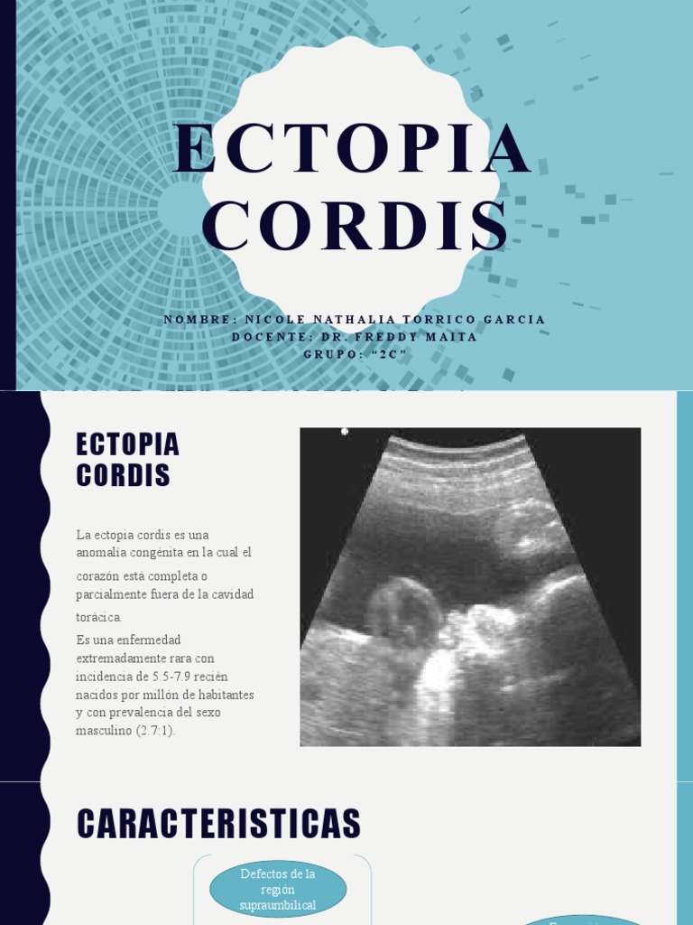 Ectopia Cordis | PDF | El embarazo | Corazón