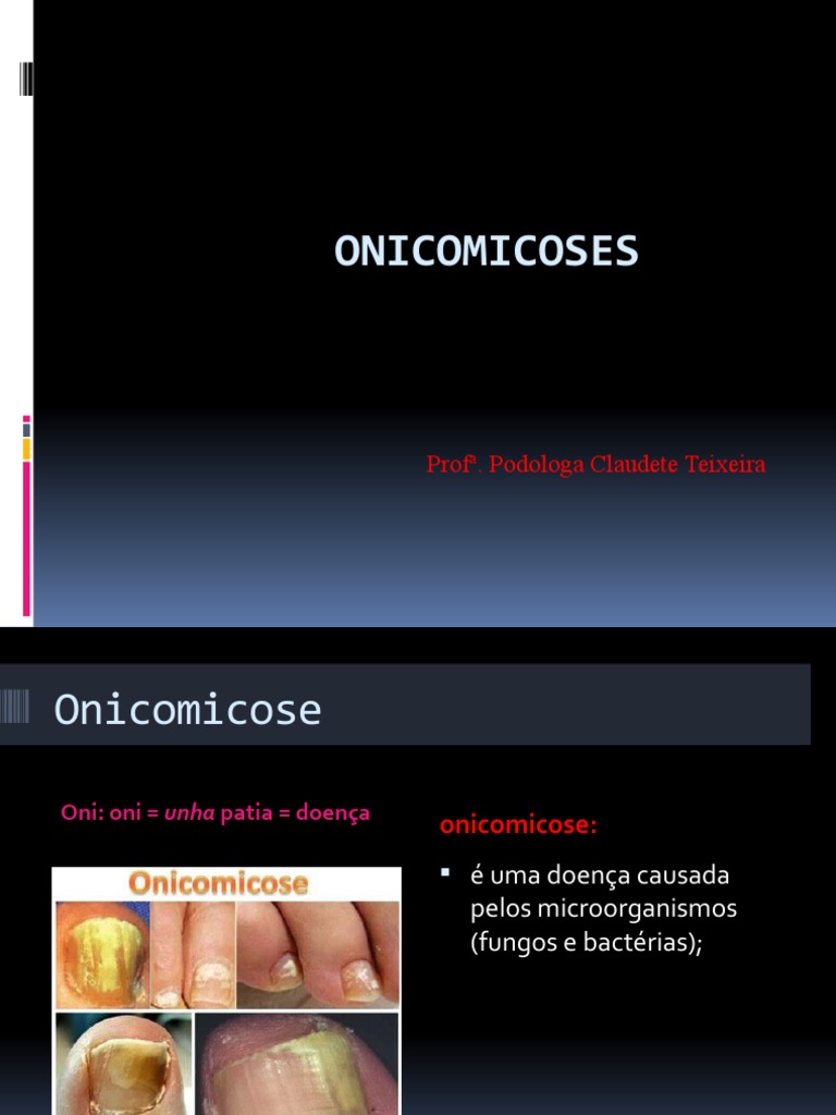 Onicomicose: causas, sintomas e tratamento | PDF | Unha | Fungo