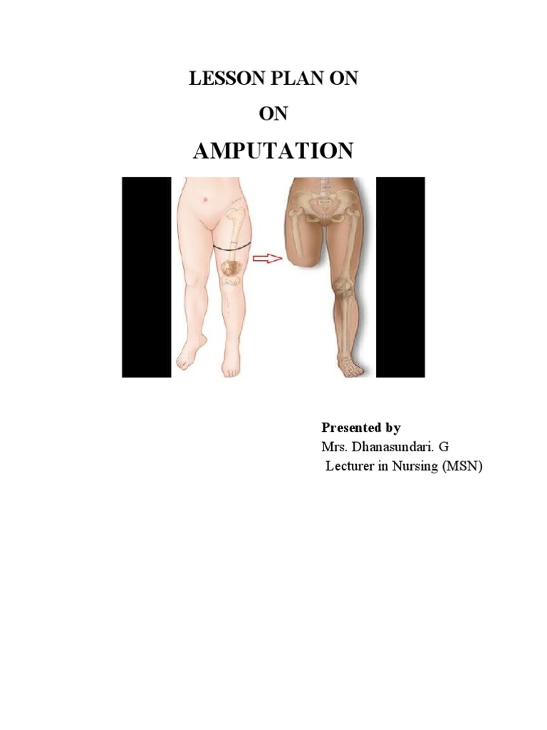 Amputation: Lesson Plan On ON | PDF | Amputation | Prosthesis
