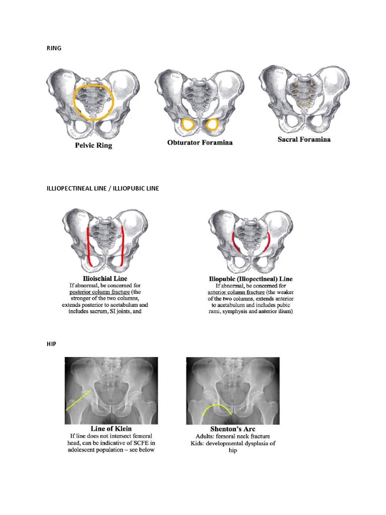Imaginer Pelvic Line Dan Pemeriksaan X-Ray Acetabulum | PDF